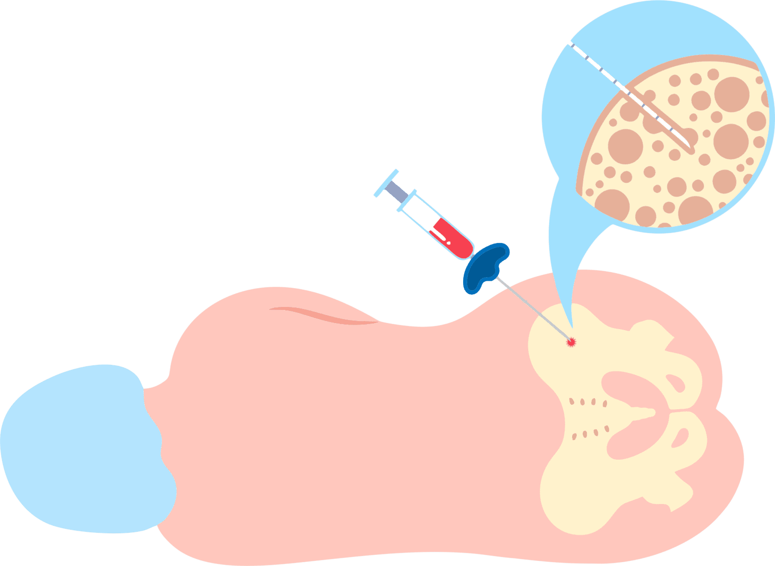 Aspirado y biopsia de médula ósea, información esencial