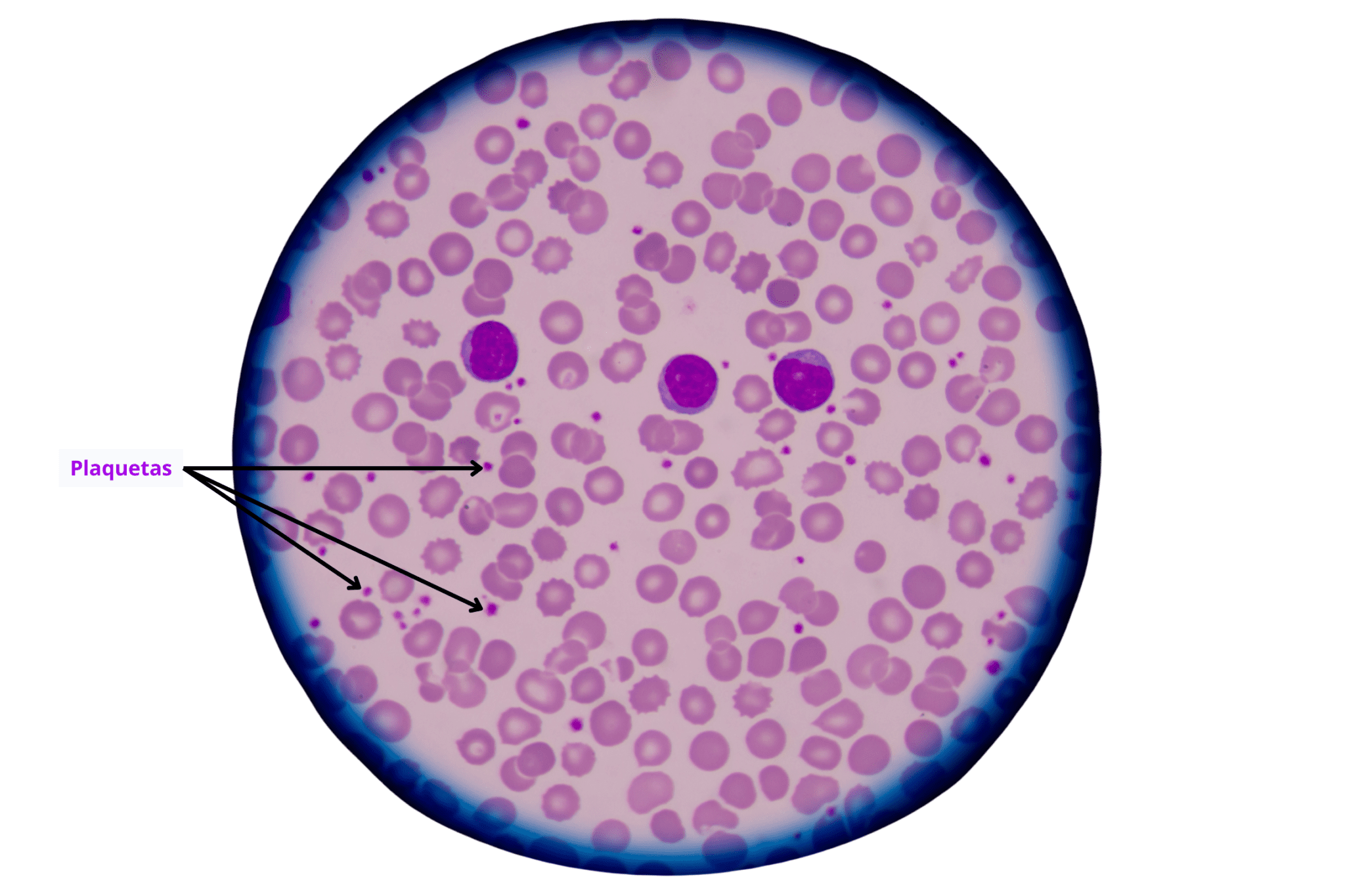Plaquetas bajas explicadas por una hematóloga